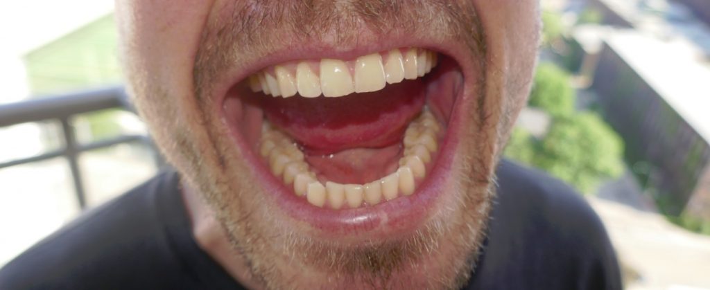Frequently Asked Questions about Wisdom Teeth – Archer Dental Frequently Asked Questions about Wisdom Teeth – Archer Dental