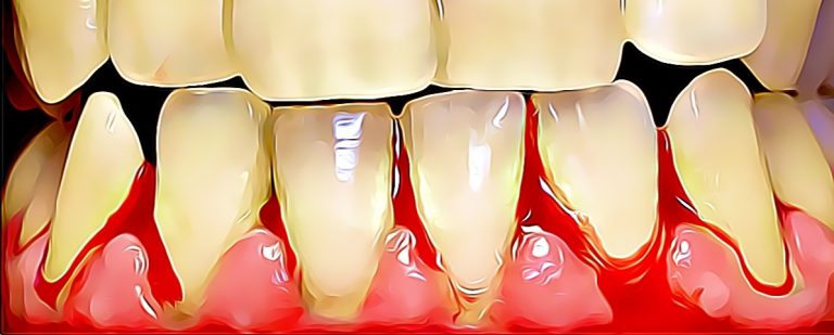 Bleeding Gums When Flossing, Brushing Teeth – Archer Dental